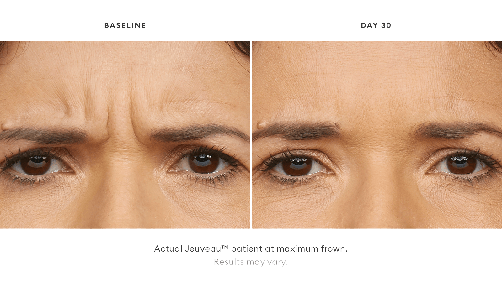 Jeuveau™ in Shreveport, LA | Jade MediSpa at The Wall Center